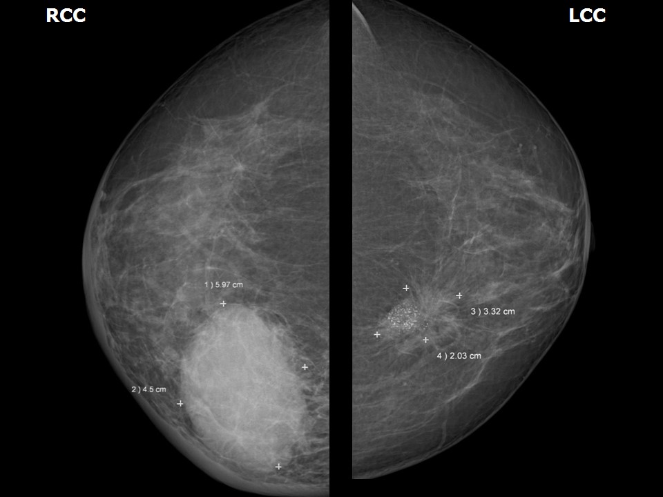 Atlas Of Breast Cancer Early Detection Atlas Of Breast Cancer Early Detection