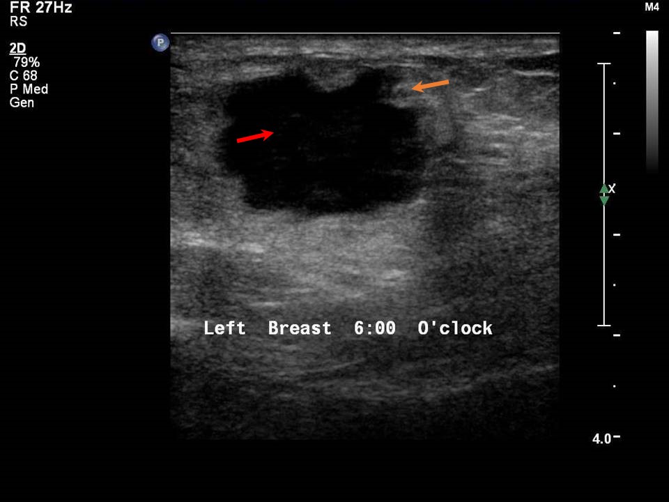 Atlas Of Breast Cancer Early Detection