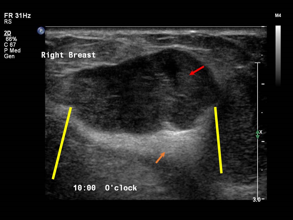 Atlas Of Breast Cancer Early Detection Atlas Of Breast Cancer Early Detection