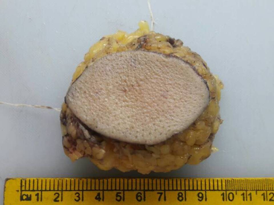 Atlas of breast cancer early detection