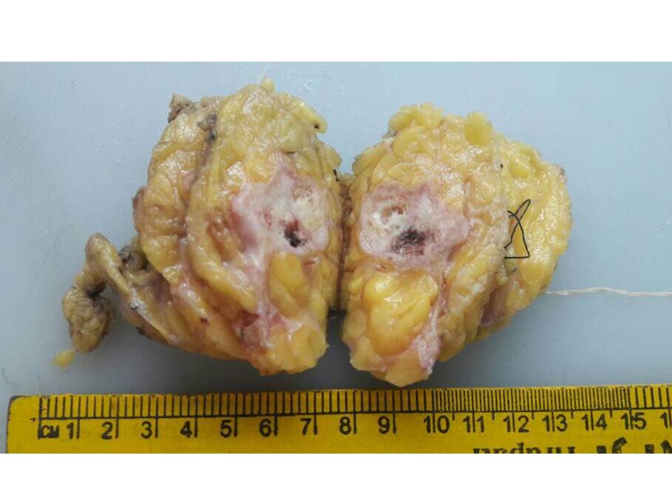 Atlas of breast cancer early detection