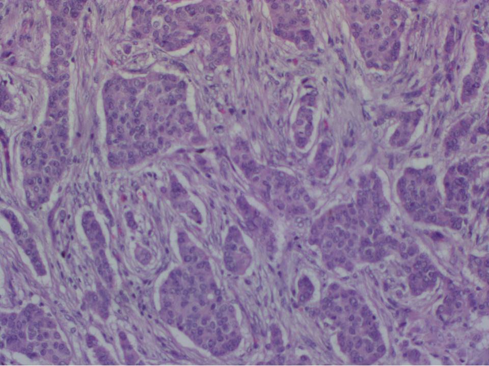 Atlas of breast cancer early detection