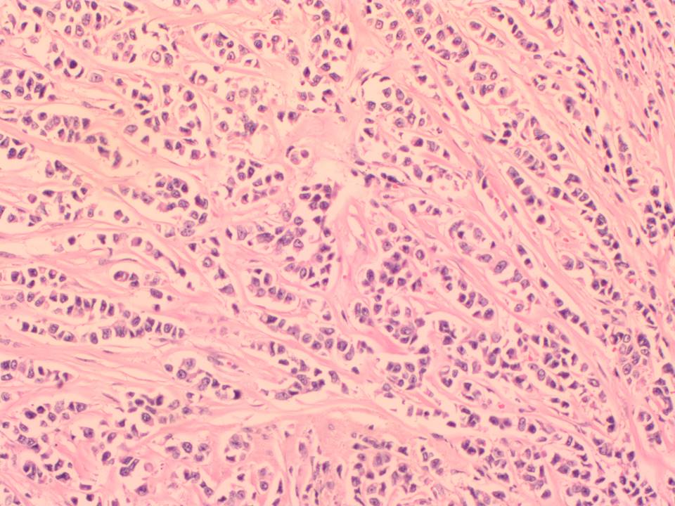 Atlas of breast cancer early detection