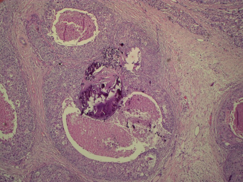 Atlas of breast cancer early detection