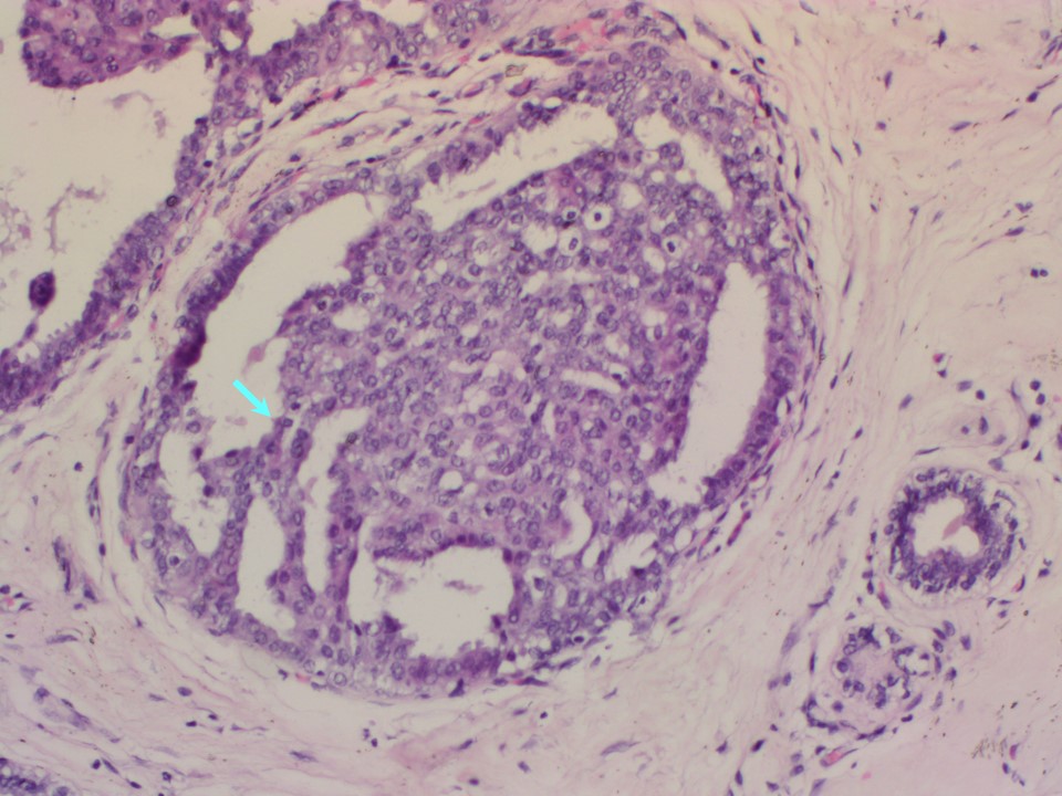 Atlas of breast cancer early detection