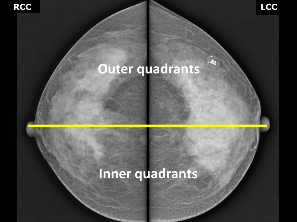 Mlo Mammography Quadrants Clock Mlo Mammography Quadrants Clock