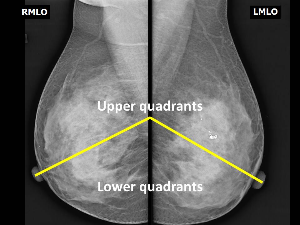 Abnormal Mammogram