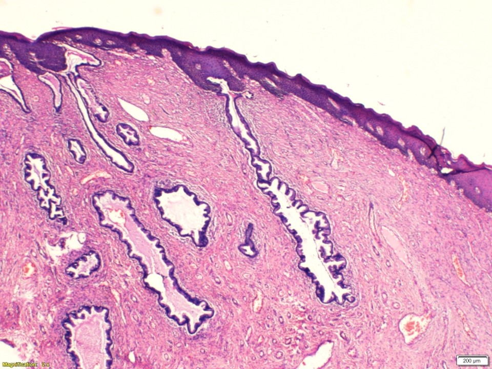 Using HPV tests for cervical cancer screening and managing HPV-positive ...