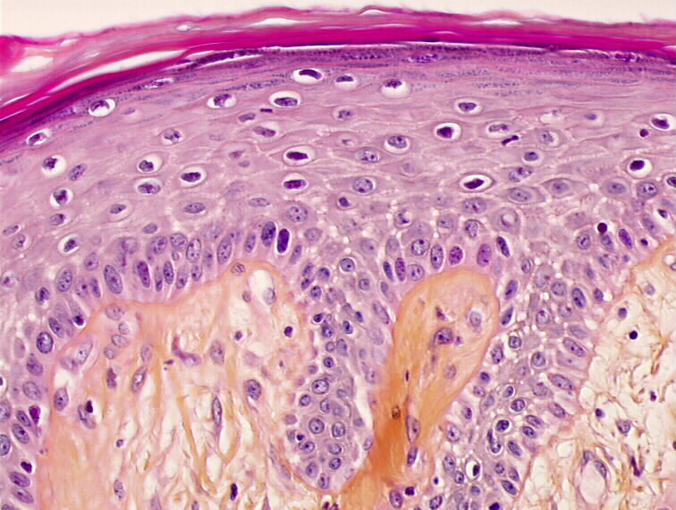 Histopathologie et cytopathologie du col utérin - atlas numérique ...