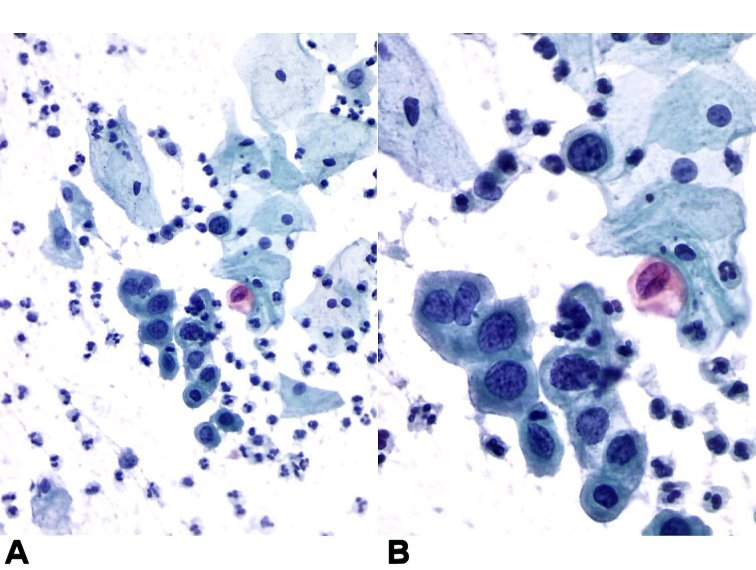 Histopathologie et cytopathologie du col utérin - atlas numérique ...