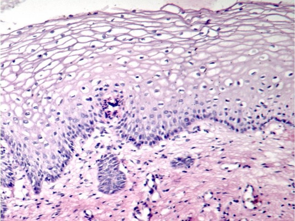Atlas of visual inspection of the cervix with acetic acid for screening ...